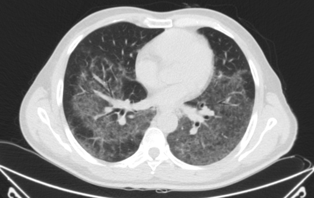 PneumoCystis Pneumonia (PCP) – RadiodiagnosticAndo