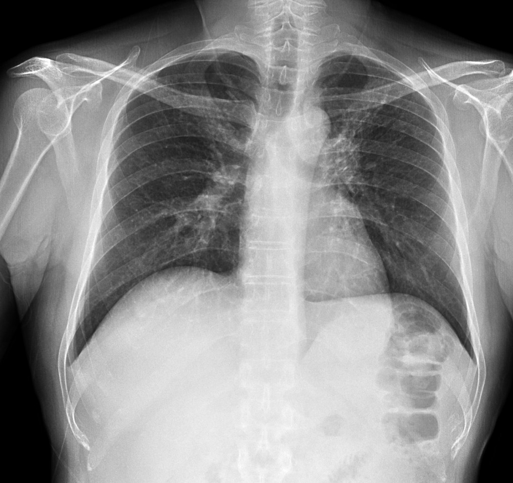 PneumoCystis Pneumonia (PCP) – RadiodiagnosticAndo