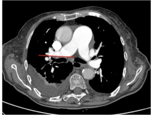TromboEmbolismo Pulmonar (TEP) Agudo y Crónico. – RadiodiagnosticAndo