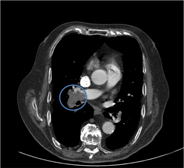 TromboEmbolismo Pulmonar (TEP) Agudo y Crónico. – RadiodiagnosticAndo
