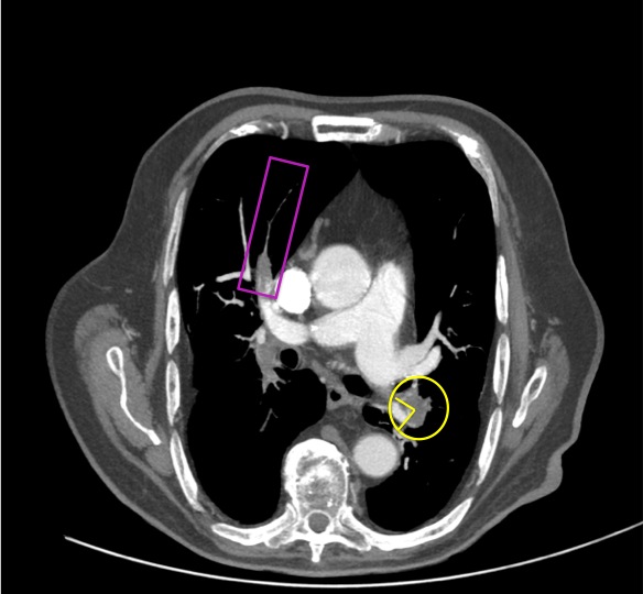 TromboEmbolismo Pulmonar (TEP) Agudo y Crónico. – RadiodiagnosticAndo