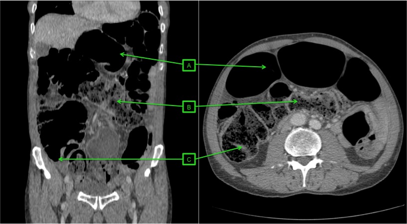 Vólvulo de Sigma. – RadiodiagnosticAndo