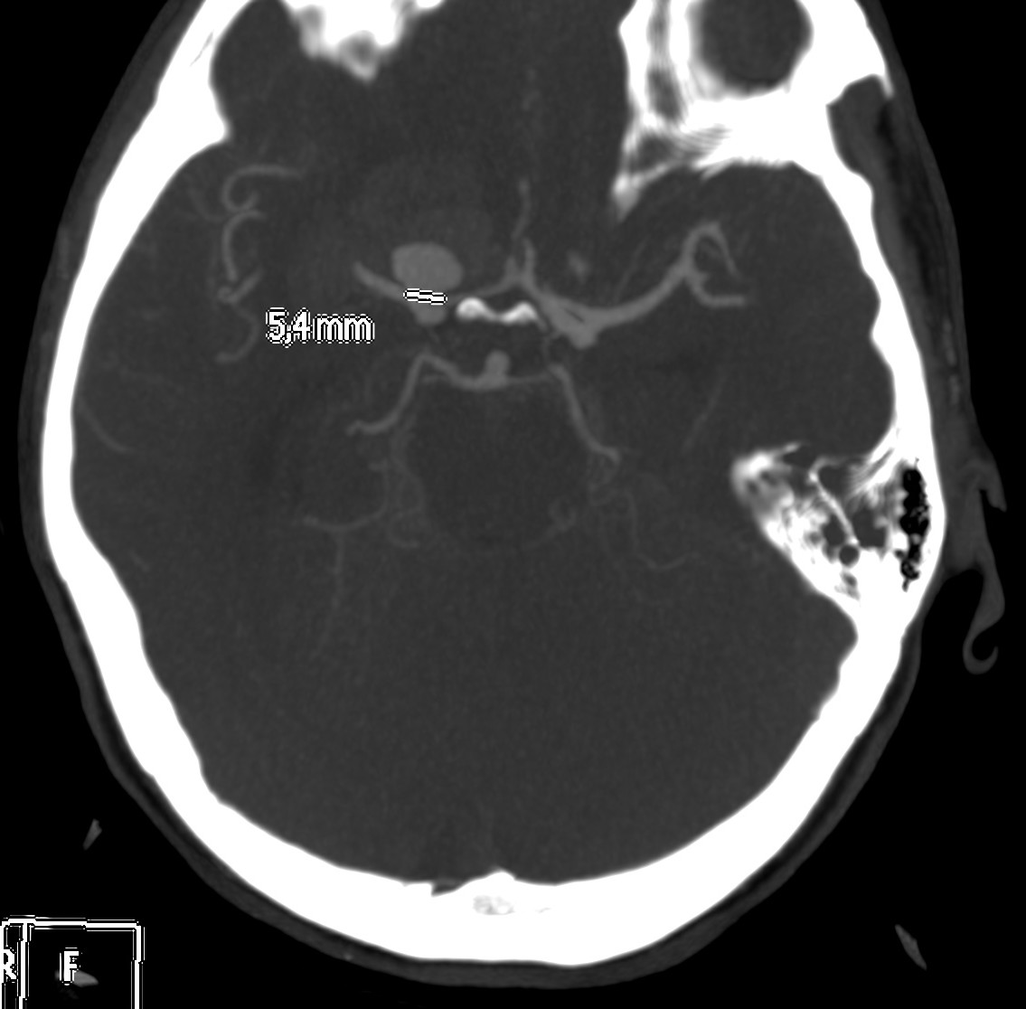 Hemorragia subaracnoidea. – RadiodiagnosticAndo