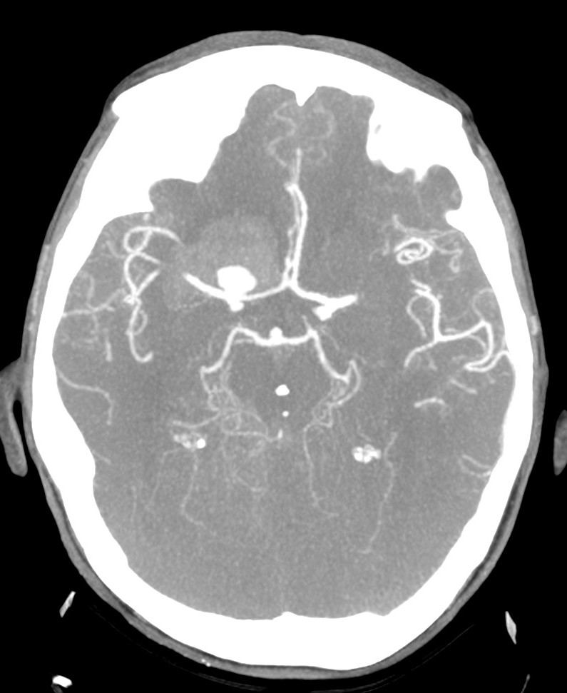 Hemorragia subaracnoidea. – RadiodiagnosticAndo