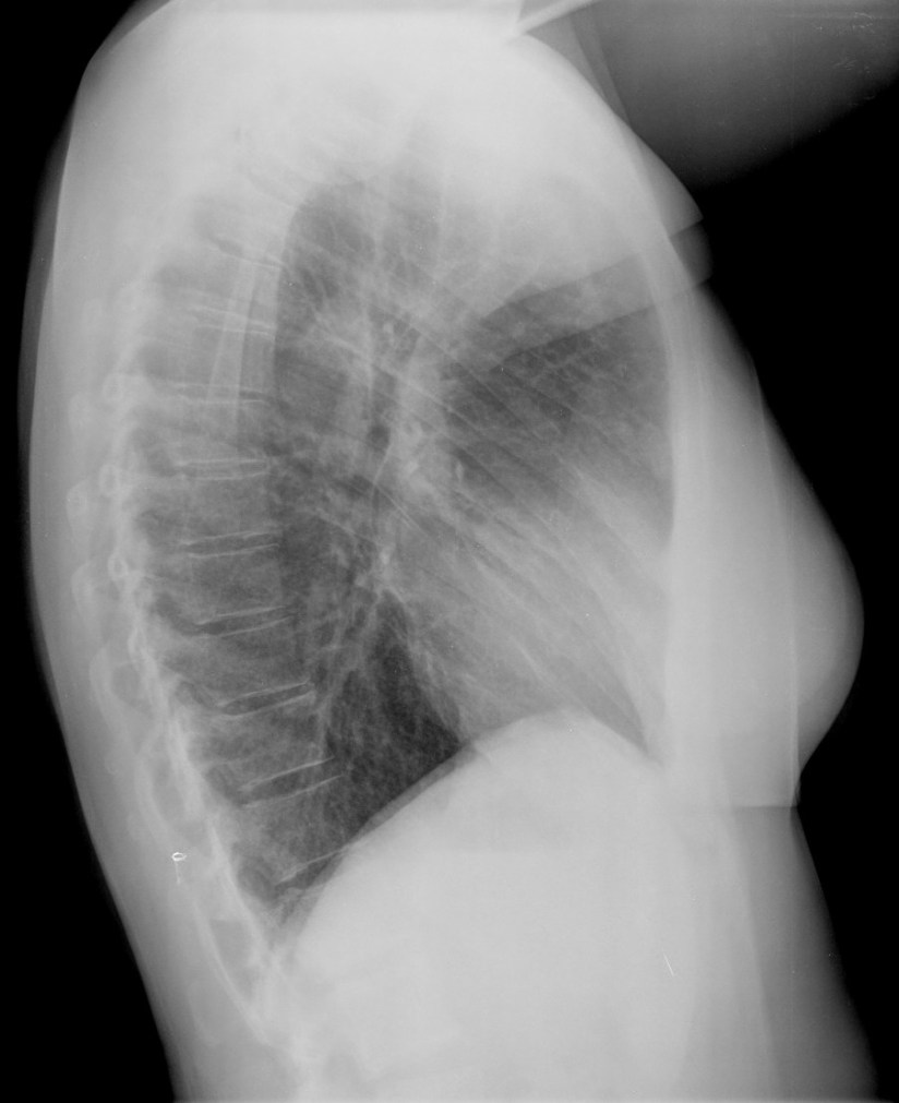 Placa simple TÓRAX. – RadiodiagnosticAndo