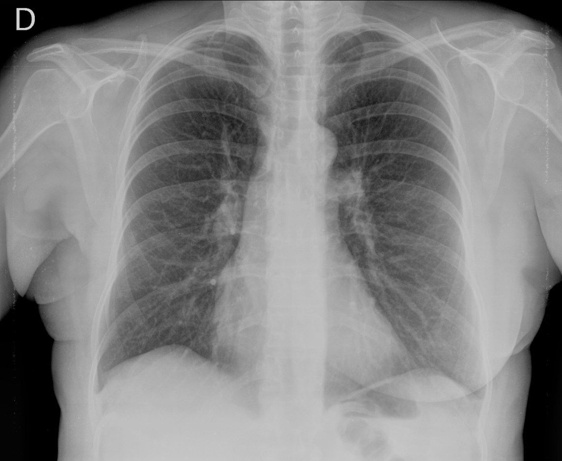 Placa simple TÓRAX. – RadiodiagnosticAndo