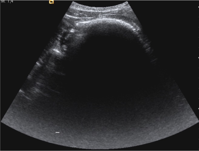 Bezoar Gastrointestinal. – RadiodiagnosticAndo