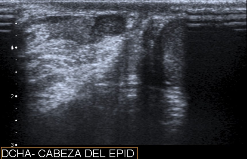 Ecografía del escroto agudo: Torsión Testicular vs Infección ...
