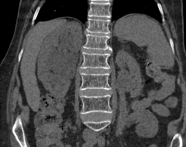 Pielonefritis Aguda y Crónica. – RadiodiagnosticAndo