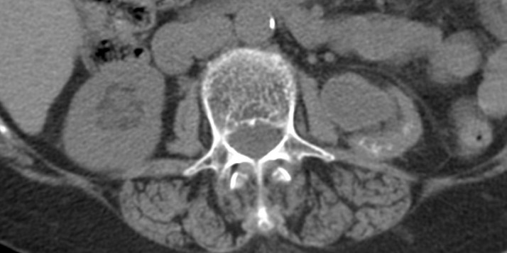 Pielonefritis Aguda y Crónica. – RadiodiagnosticAndo