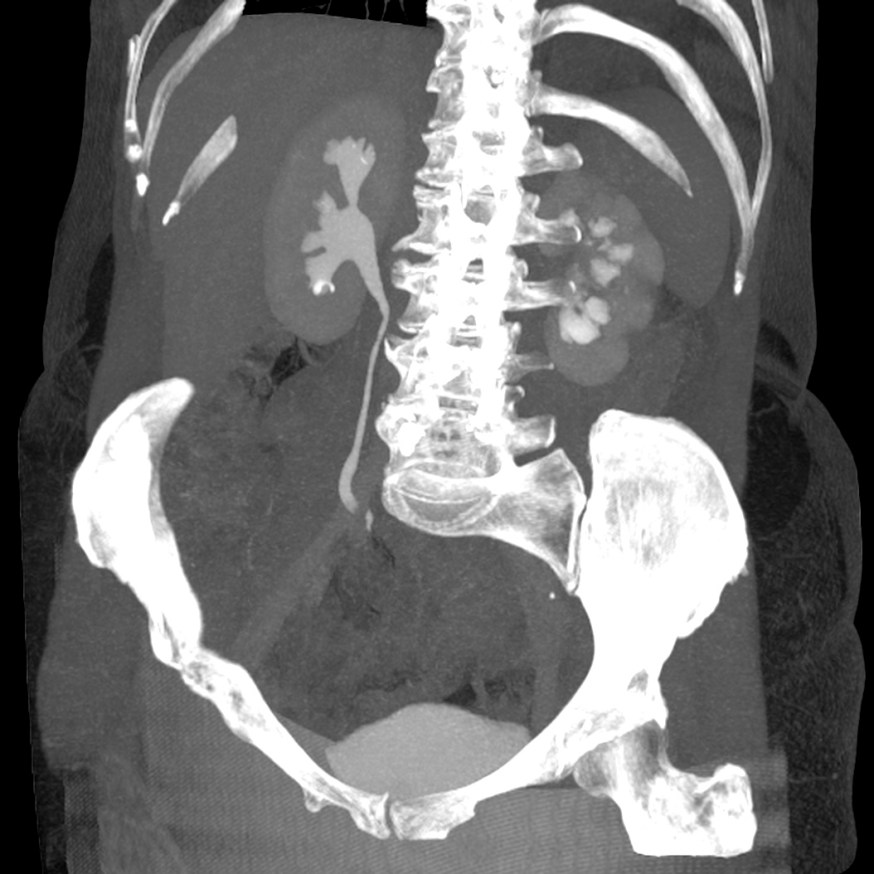 Tuberculosis Renal. – RadiodiagnosticAndo