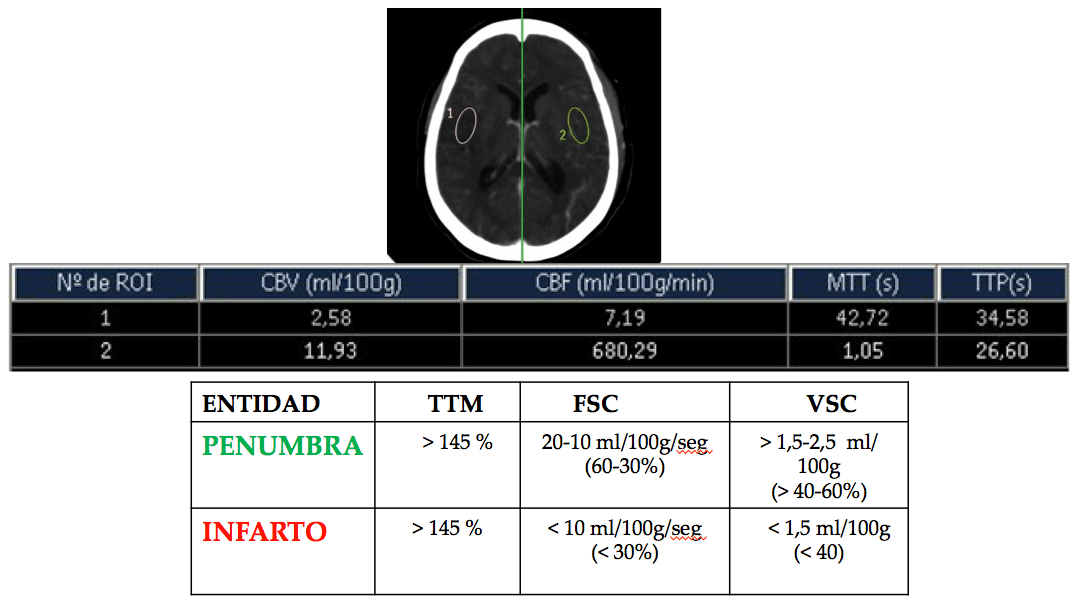 TC perfusión y AngioTC, las otras dos patas del TC Multimodal para el ...