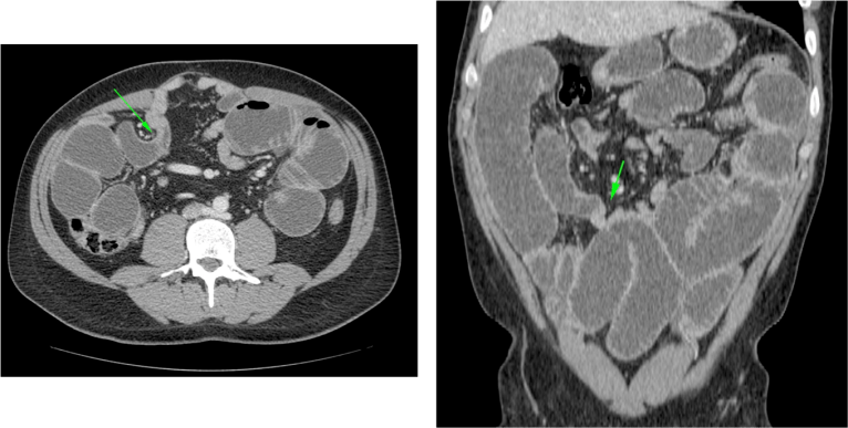 Obstrucción intestinal. – RadiodiagnosticAndo