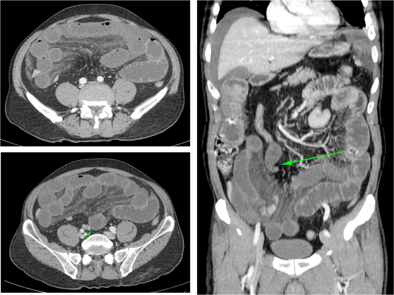 Obstrucción intestinal. – RadiodiagnosticAndo